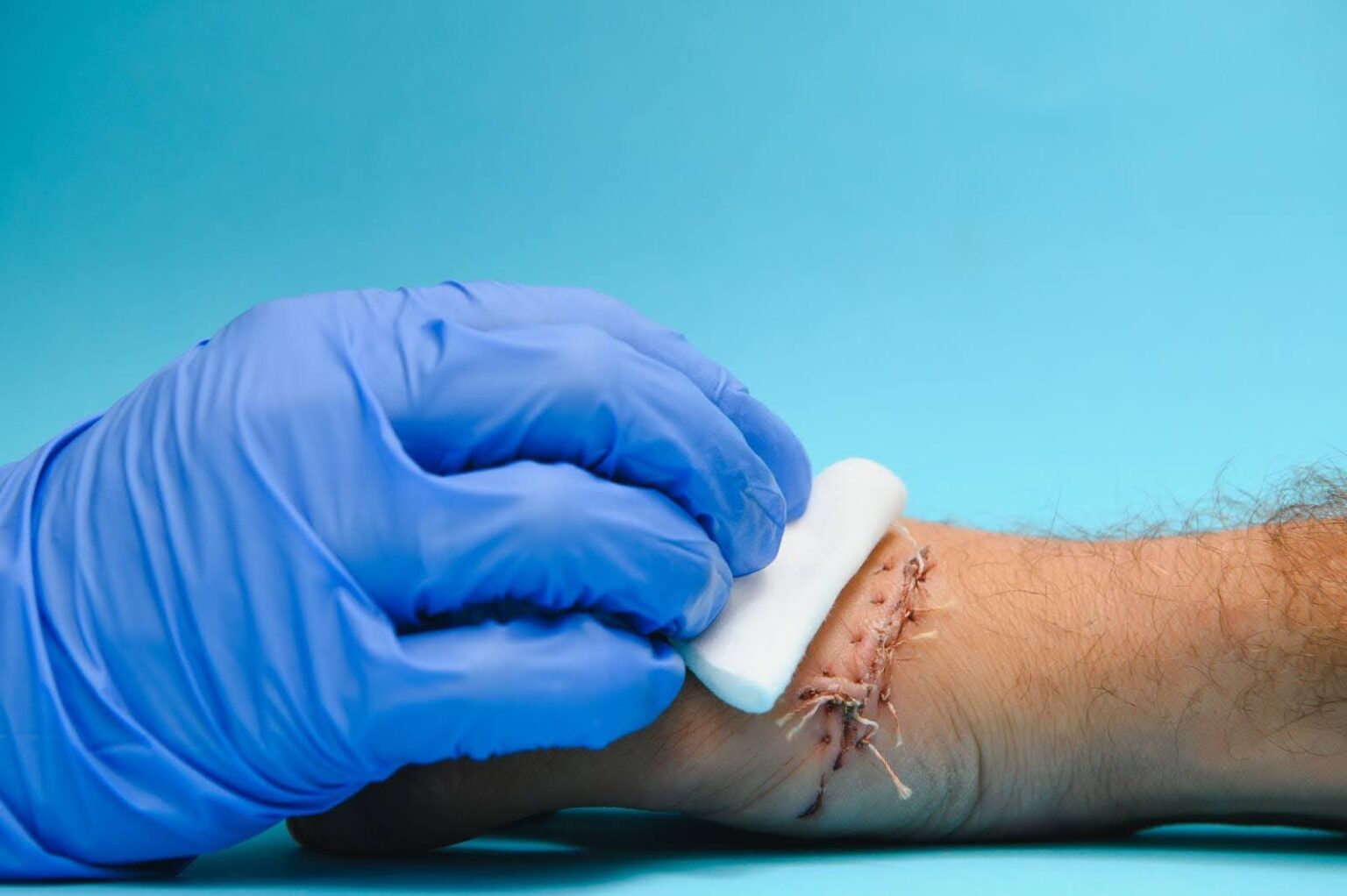 How to Identify a Tunneling Wound Early and Prevent Complications